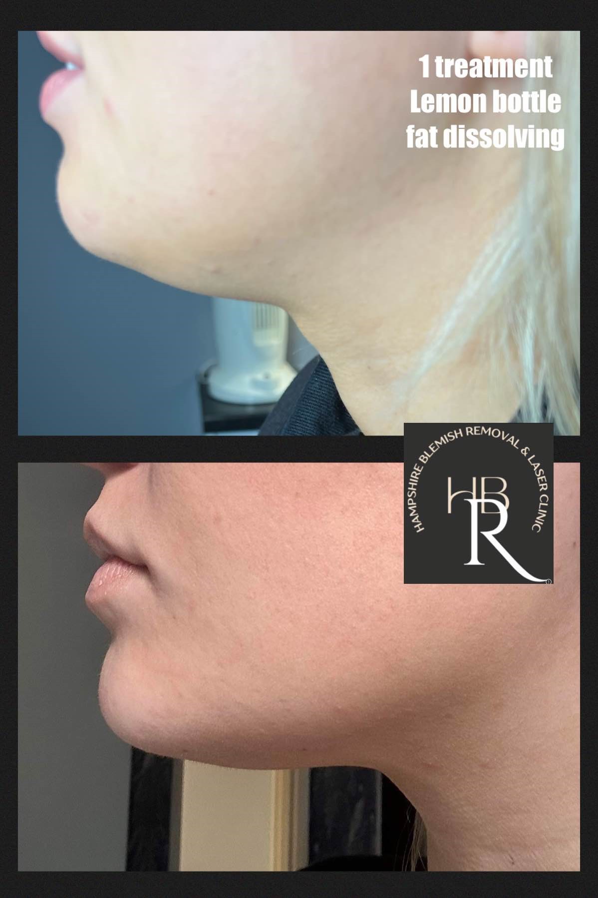 Fat Dissolving | Hampshire Blemish Removal