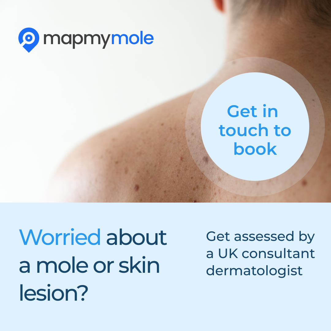 Map My Mole | Hampshire Blemish Removal